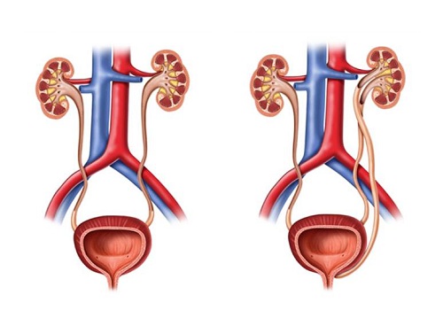 Bé gái bị tật niệu quản đôi hiếm gặp