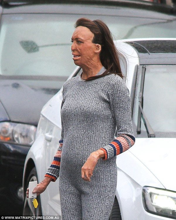 Chuyện mang thai của người mẫu Turia Pitt mang khuôn mặt biến dạng với ...