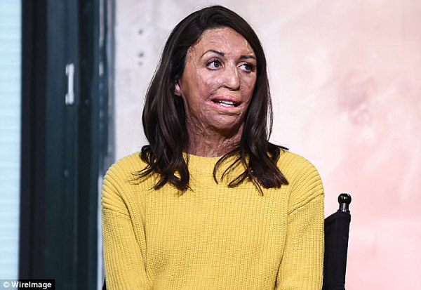 Chuyện mang thai của người mẫu Turia Pitt mang khuôn mặt biến dạng với ...